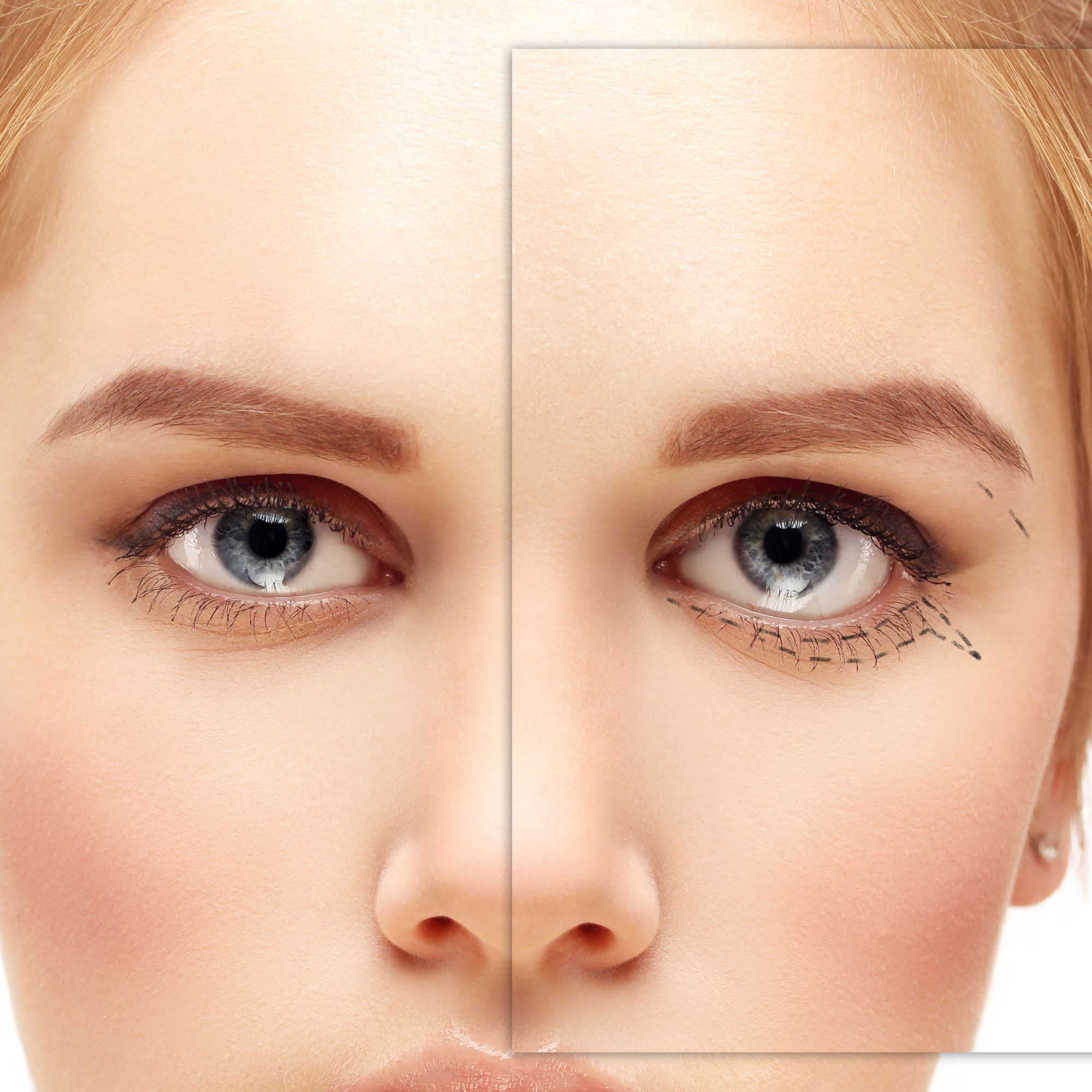 Onderooglidcorrectie binnen 2 weken | Kliniek het Bolwerk