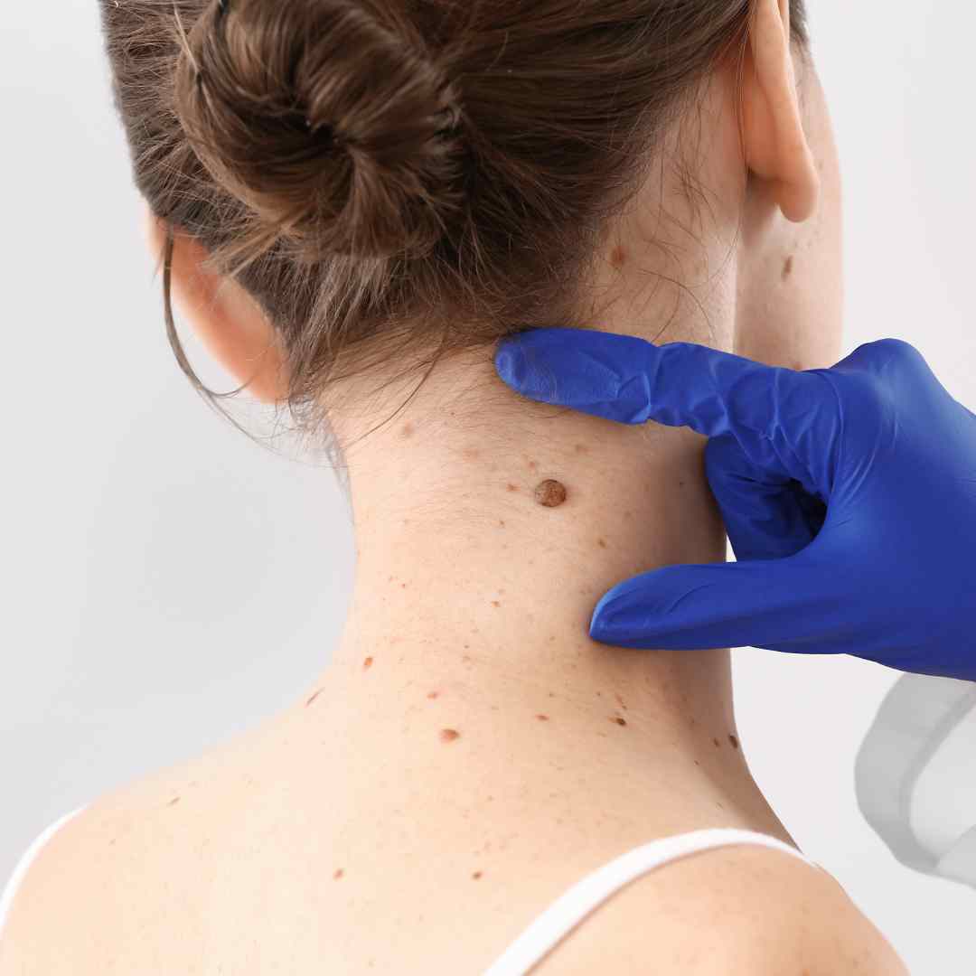 Moedervlek verwijderen Haarlem - Binnen 2 Weken Behandeld